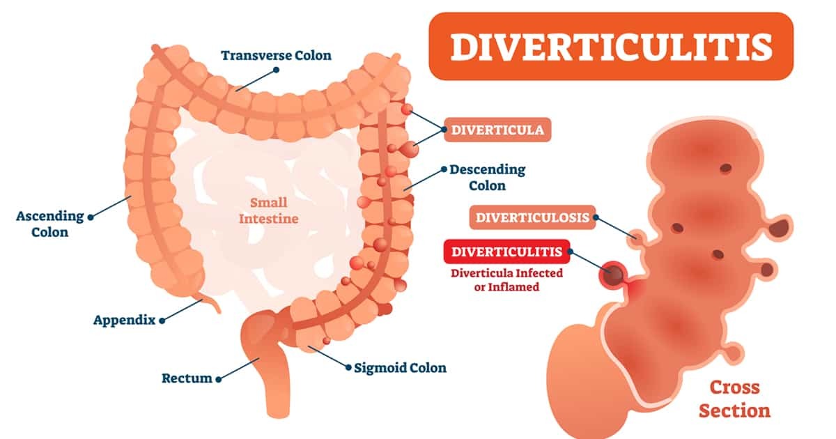 Diverticulitis Disease And Diet Cary Gastroenterology Associates Diverticulitis Disease And Diet Cary Gastroenterology Associates