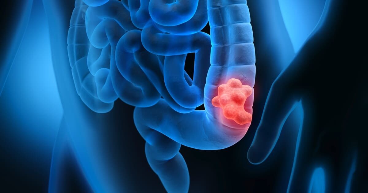 Cary Gastroenterology Associates | What to Know About Colorectal…