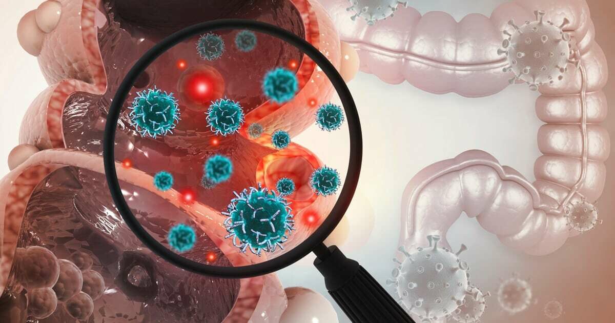 Cary Gastroenterology Associates | How Is Colon Cancer Diagnosed and…