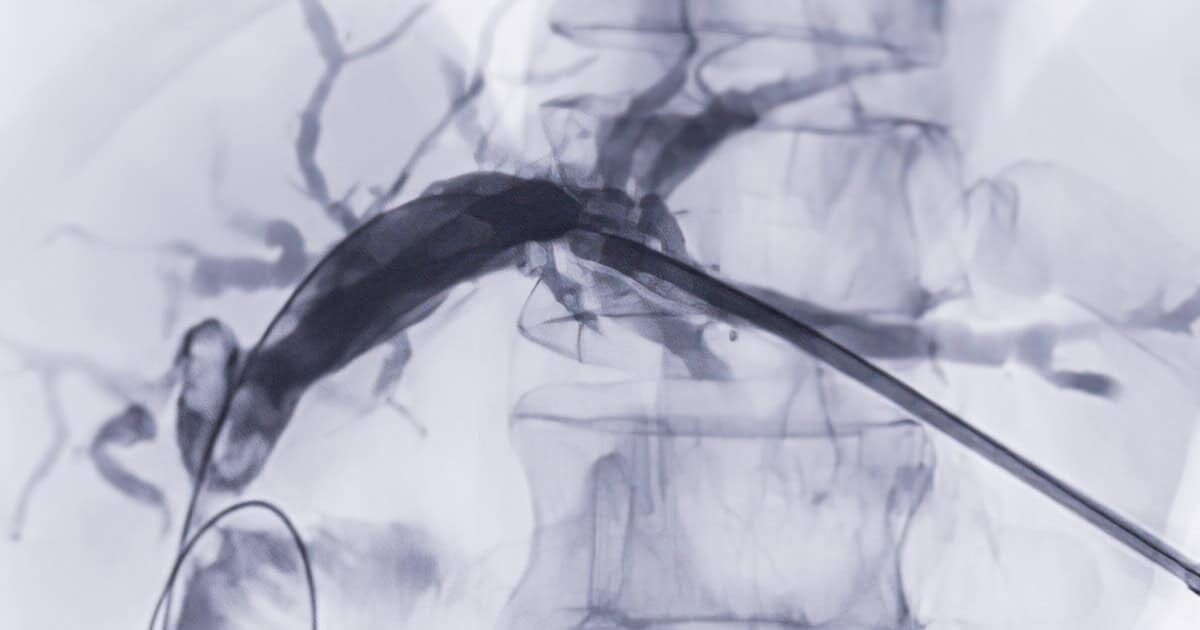 Cary Gastroenterology Associates | What is Endoscopic Retrograde…
