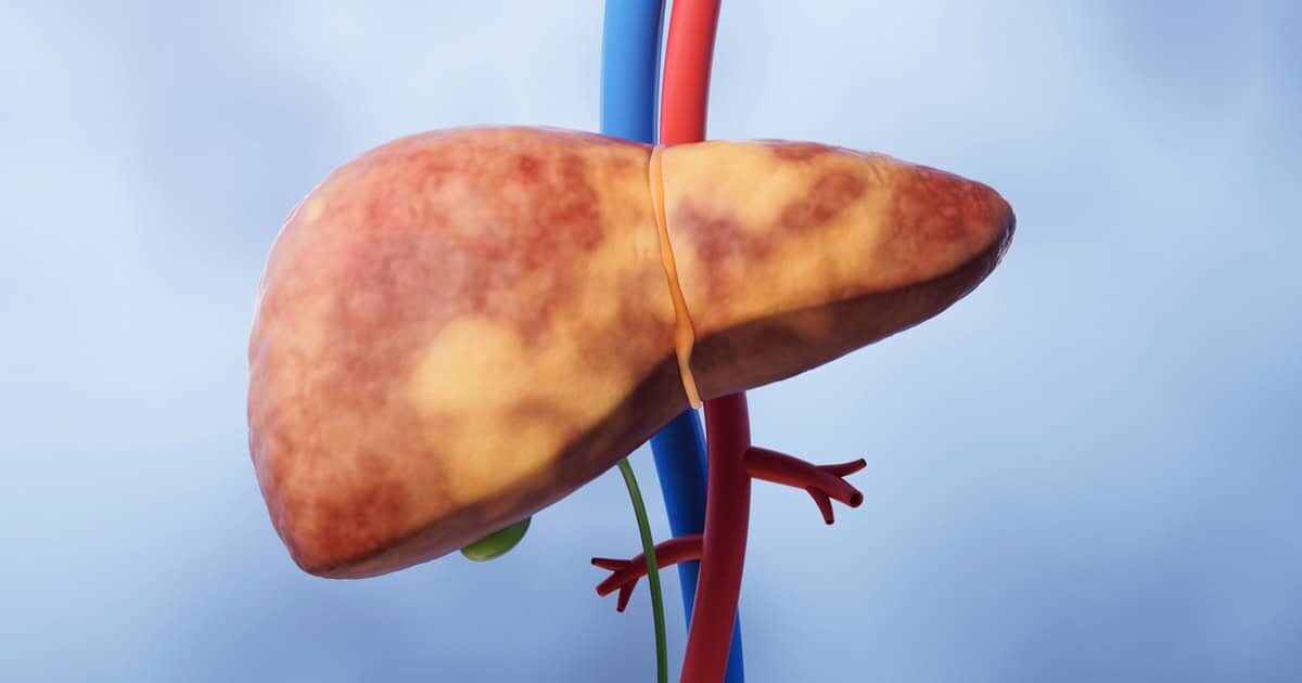 Cary Gastroenterology Associates | What Is MAFLD?